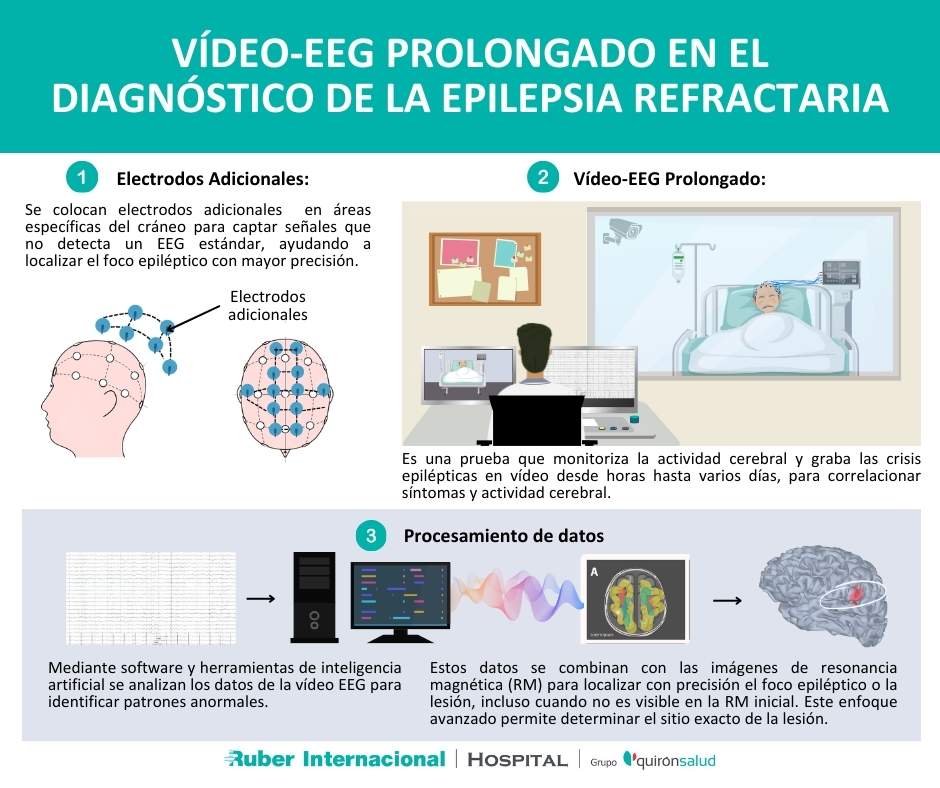 Epilepsia Refractaria : Diagnóstico y tratamiento avanzado